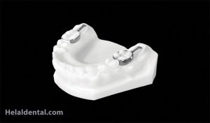 Distal Shoe Space Maintainer | Helal Dental Company