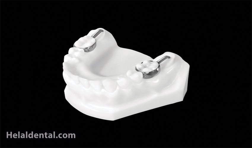 Distal Shoe Space Maintainer | Helal Dental Company
