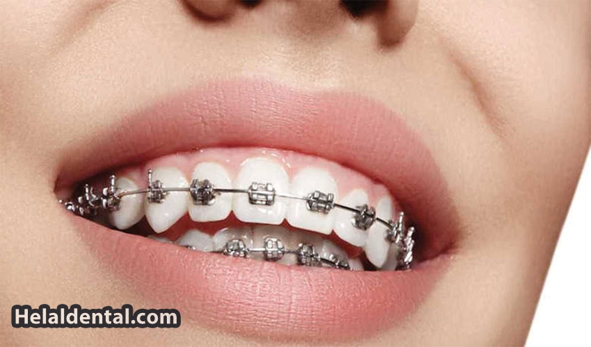 Brackets | A Guide to Orthodontic Brackets