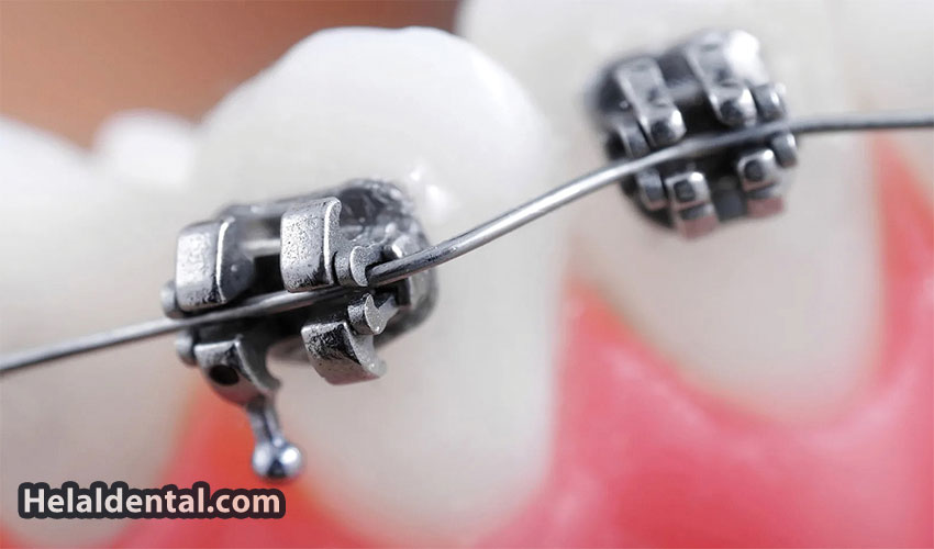 Distal Shoe Space Maintainer | Helal Dental Company