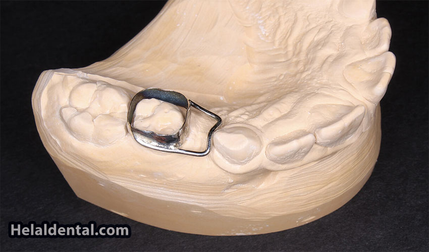 Dental Space Maintainer | Helal Dental Company