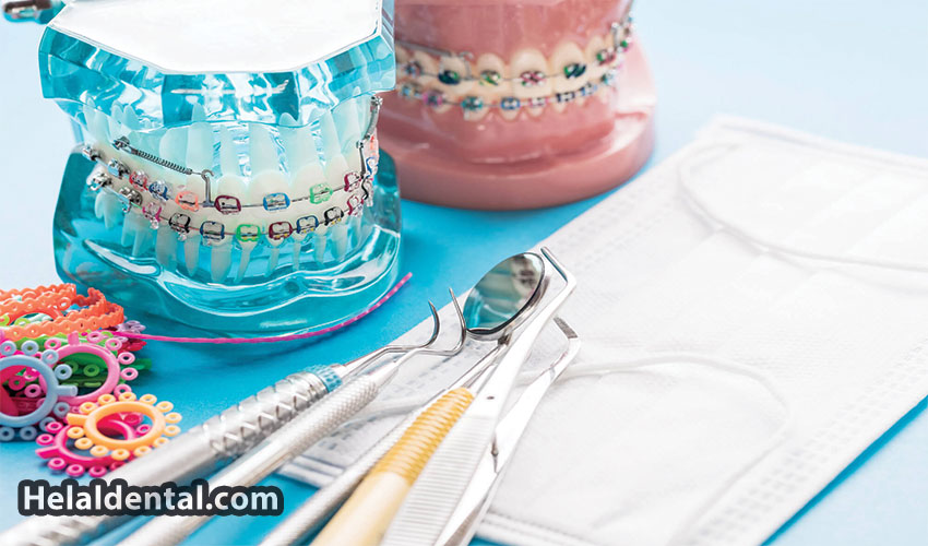 Guide to Essential Orthodontic Tools and Their Roles