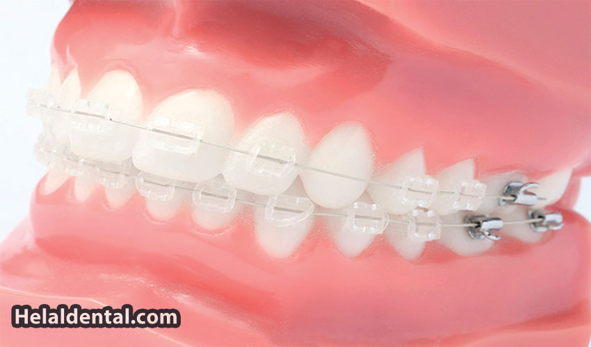 Orthodontic Wires | Everything About Orthodontic Wires