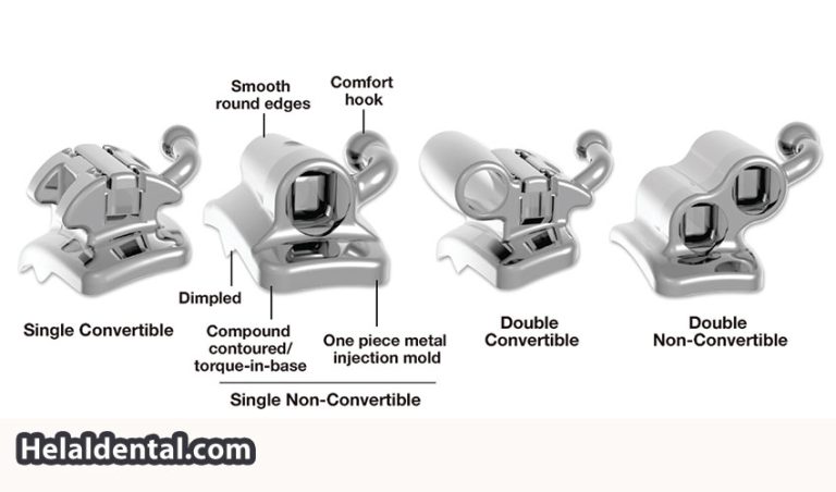 Buccal Tubes Types, Benefits, and dvancements | Helal Dental